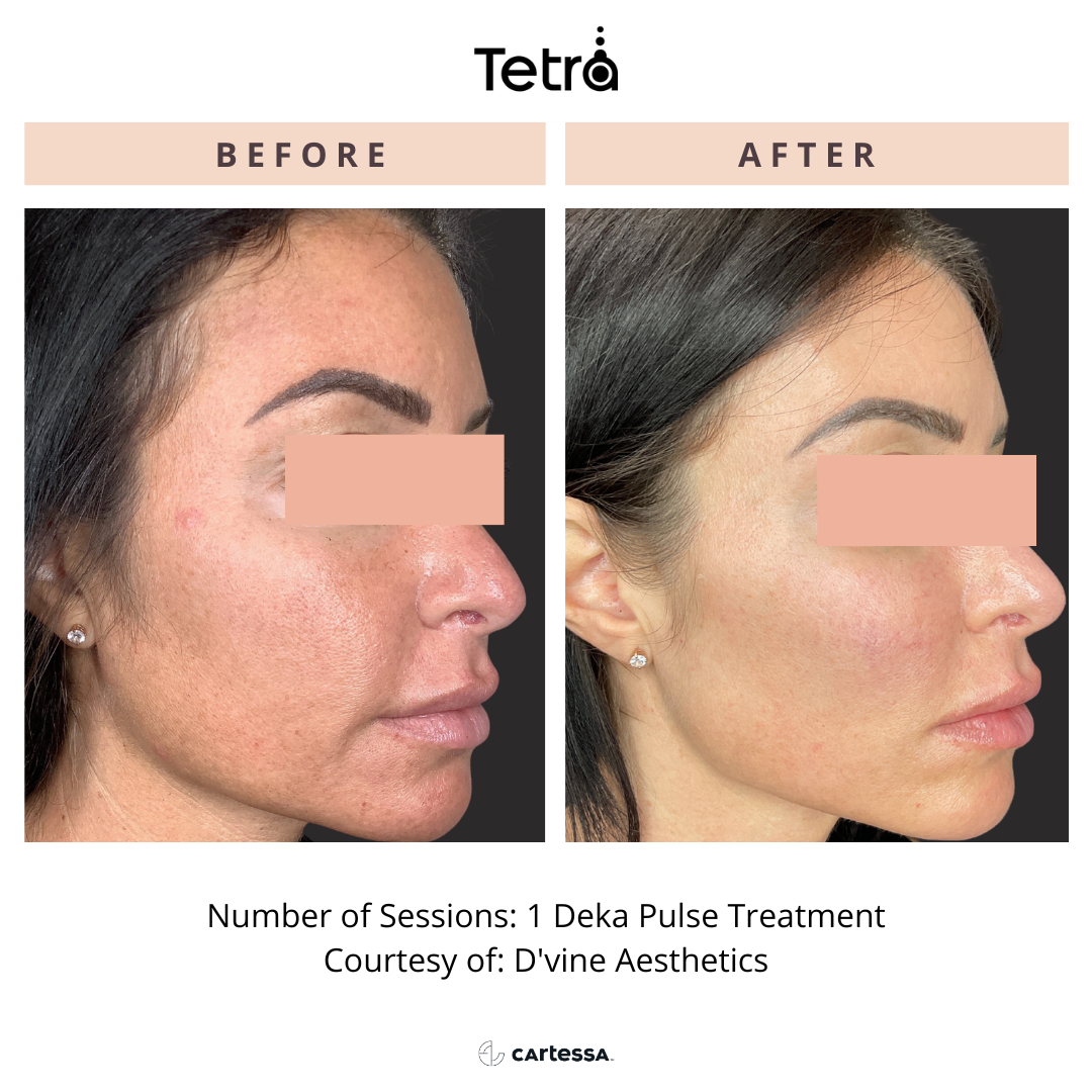 CoolPeel DEKA CO2 Treatment | Asia Pacific Aesthetics
