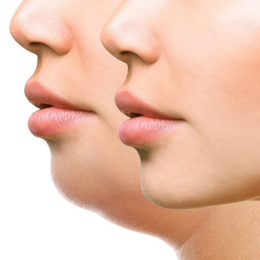 Kybella | Asia Pacific Aesthetics